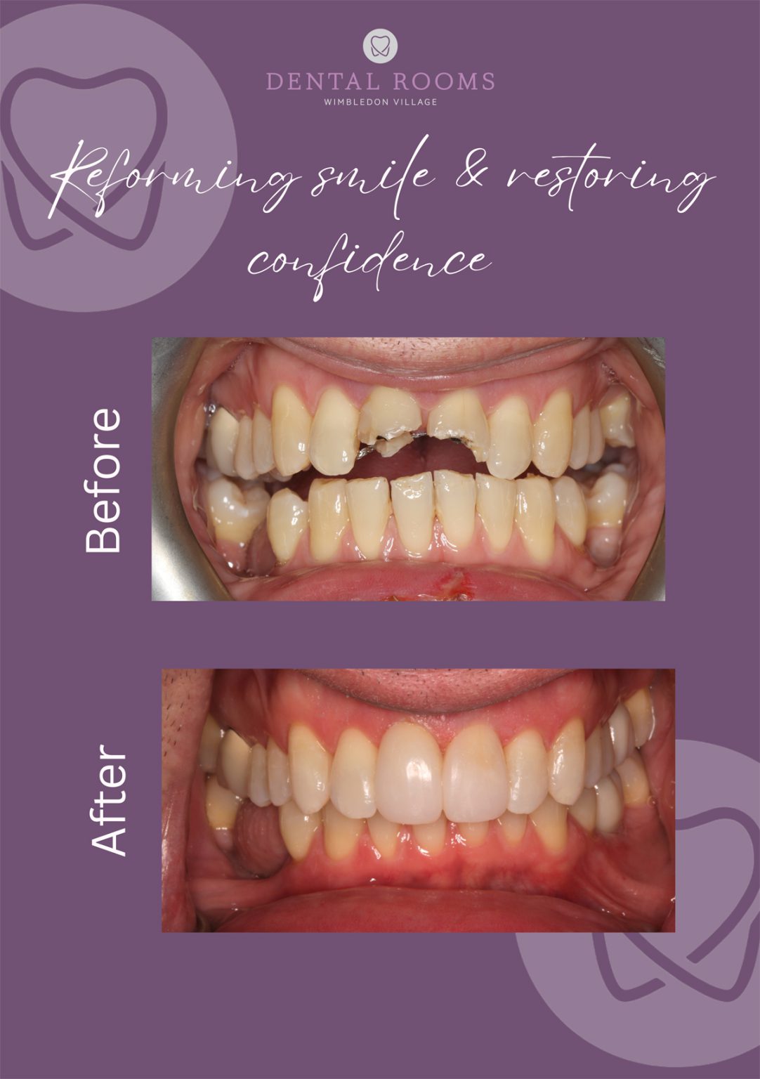 Smile Refreshed: Restoring Worn & Chipped Teeth with Injection Moulding ...